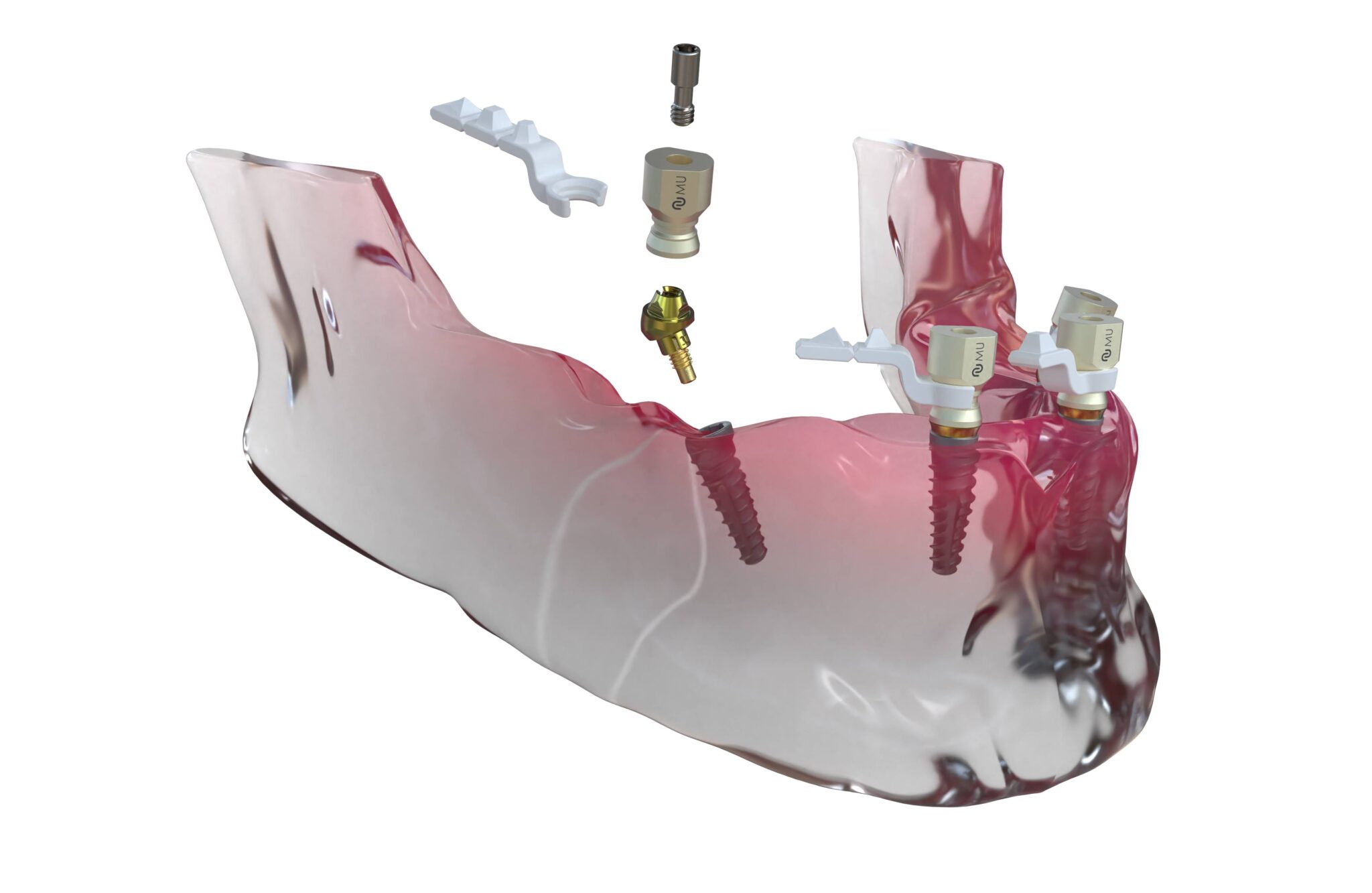 Full arch flexibility with Neoss4+